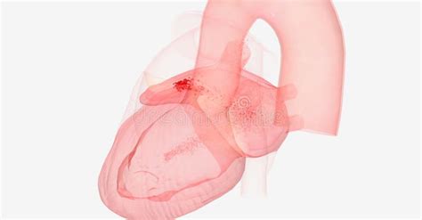 The Left Atrial Appendage Thrombus Stock Illustration Illustration Of Heart Valve 279145371