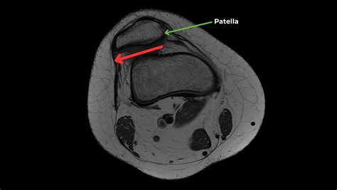 Patella Dislocation