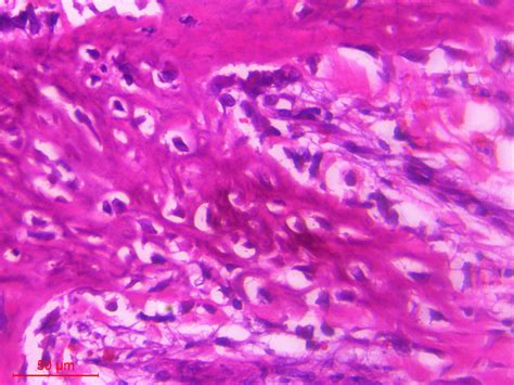 Pathology Outlines Myositis Ossificans