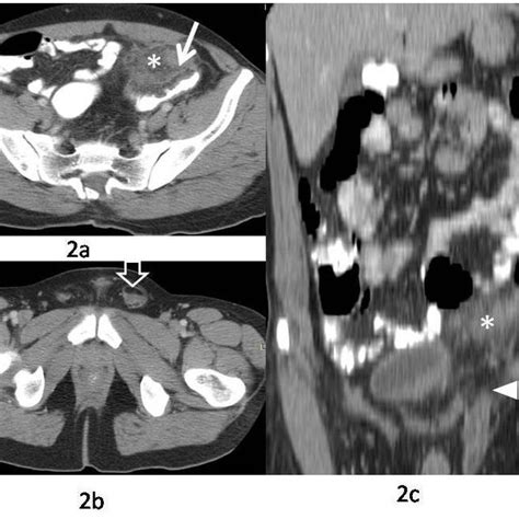 Intra Op Images 3a Thick Left Spermatic Cord White Arrow 3b