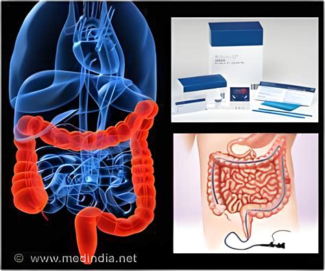 New Clinical Guidelines On The Diagnosis And Management Of Diverticulitis