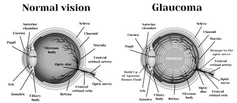 Glaucoma Treatment Options In Sydney Binetter Eye Centre