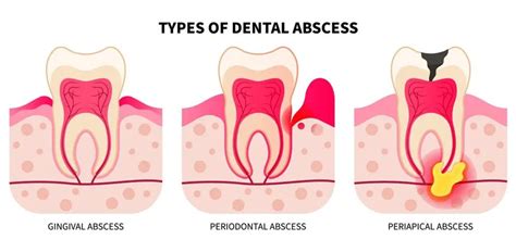 Recognizing And Treating A Dental Abscess A Comprehensive Guide
