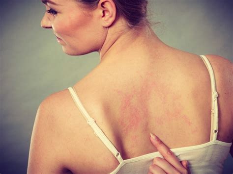 Descubre Los Remedios Caseros Para La Eczema Remedios Caseros