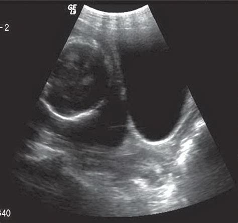 Second And Third Trimester Pregnancy Radiology Key