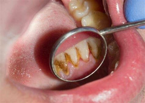 How To Remove Tartar From Teeth Without A Dentist