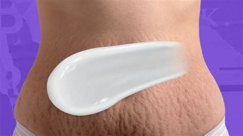 Quita tus estrías con esta crema casera a base de 4 plantas comunes en