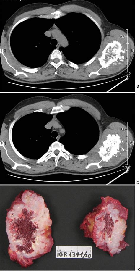 Secondary Peripheral Chondrosarcoma Arising In Solitary Osteochondroma