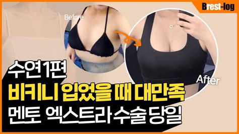 가슴성형 브이로그 1편 A컵에서 꽉찬 풀C컵 후기 멘토 엑스트라 스무스 YouTube