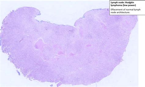 Lymph Node Large Cell Lymphoma Nus Pathweb Images And Photos Finder