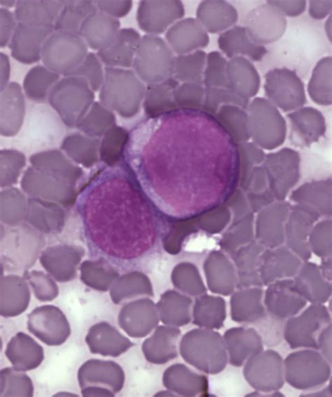 Enzyme Linked To Poor Survival Rate In Leukemia Patients Identified