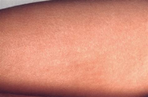 Spider Bite Rash Pictures