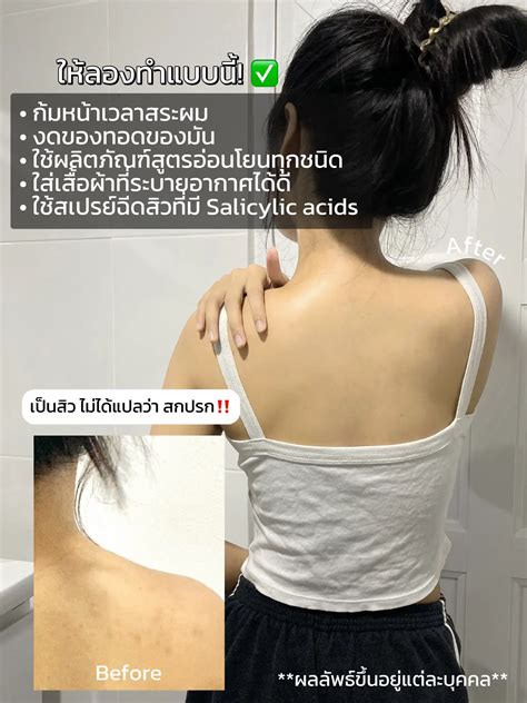 จริงหรือไม่ เป็นสิวที่หลัง สกปรก สาเหตุเกิดจากอะไรบ้าง แกลเลอรีที่โพสต์โดย B Bell🍒 Lemon8