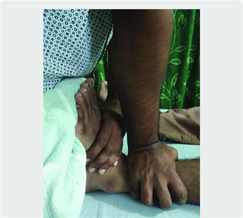 Ap Mobilization Of The Talus Download Scientific Diagram