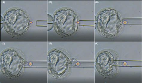 A Novel Trophectoderm Biopsy Technique For All Blastocyst Stages Pmc
