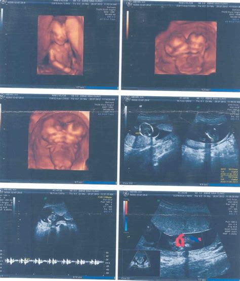 Dicephalic Parapagus Tribrachius Conjoined Twins In A Triplet Pregnancy