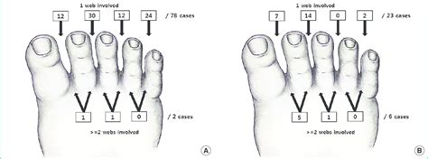 Web Distribution Of Patients A Unilateral Foot Syndactyly 80 Cases