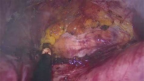 Laparoscopic Sigmoidectomy For Cancer Youtube