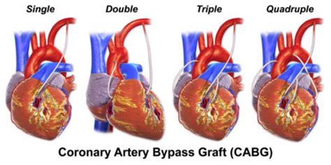 Coronary Artery Bypass Grafting Cabg Flashcards Quizlet