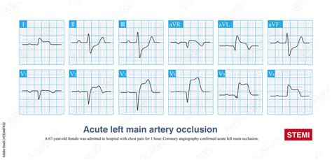 acute left main artery occlusion can cause both st segment elevation