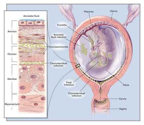 Intrauterine Infection And Preterm Delivery Nejm