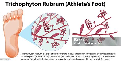 Trichophyton Rubrum Fungal Infection Stock Illustration Download