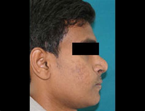 Cleft Osteotomy And Distraction Hyderabad Cleft Society