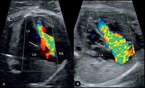 Ebstein Anomaly Tricuspid Valve Dysplasia And Tricuspid Regurgitation