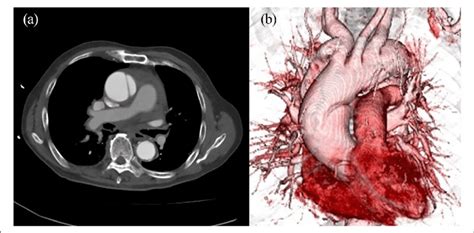 A Axial View Preoperative Contrast Enhanced Ct Dissection Is Seen In