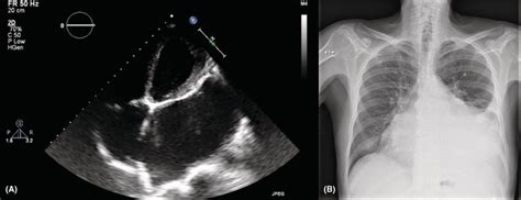 A Left Apical Four Chamber View In Transthoracic Echocardiogram