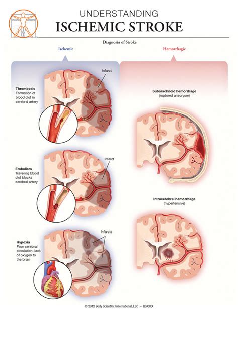 Ischemic Stroke Anatomical Wall Chart Bsi Catalog