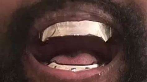 Kanye Wests New 850k Titanium Teeth Are Attention Seeking Stunt
