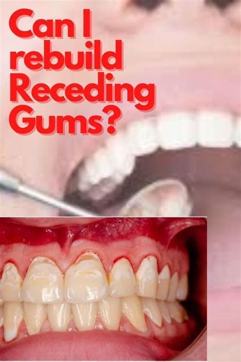 60 Second Trick Rebuilds Your Teeth And Receding Gums Overnight In 2022