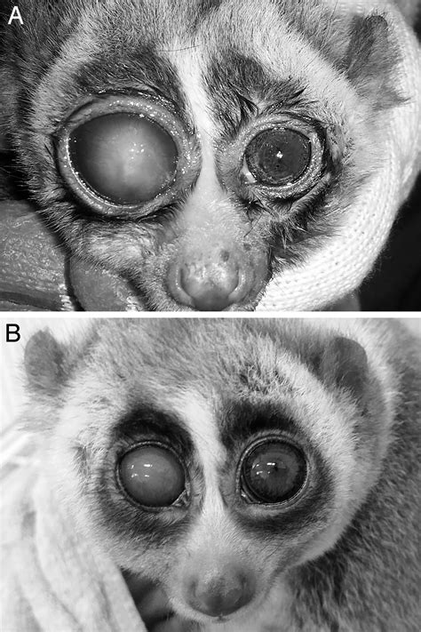 Intraocular Silicone Ball Implantation After Evisceration In A Slow