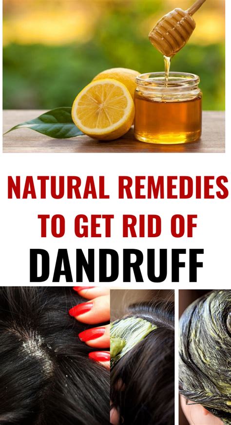How To Get Rid Of Dandruff Permanently Curly Hair Best Simple