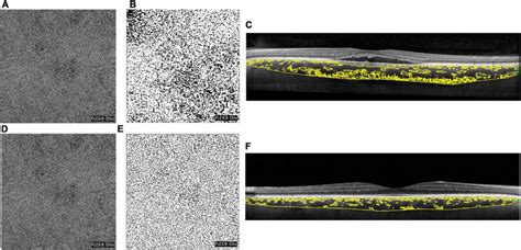 A Optical Coherence Tomography Angiography Octa Scan Of A Central