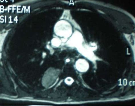 Mass In The Lung Thoracic Surgery Lung Cancer Surgery Vats
