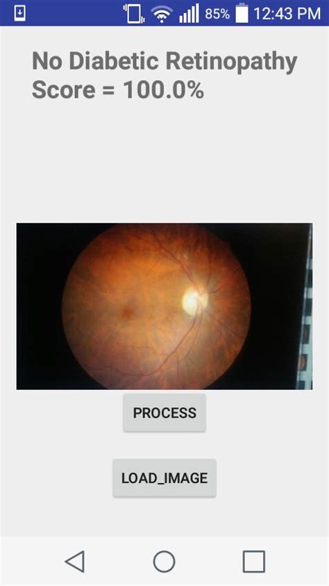 GitHub Wenwenyu Diabetic Retinopathy Detection 2 Tensorflow Based