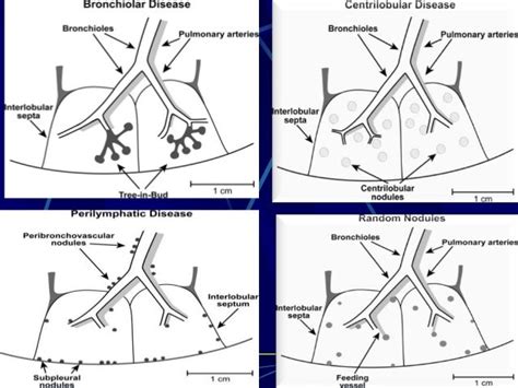 Nodular Pattern