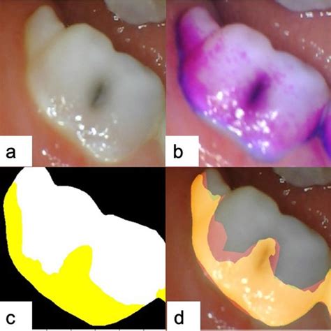 Pdf Deep Learning Based Dental Plaque Detection On Primary Teeth A