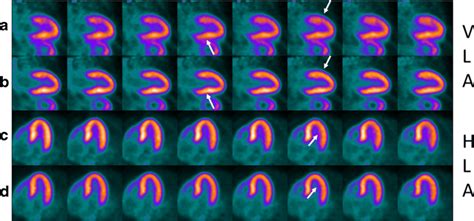Rubidium Pet Perfusion Images In A 57 Year Old Man 90 Kg Bmi