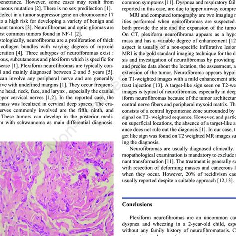 Proliferation Consisting Of Spindle Shaped Cells With Small Undulating Download Scientific