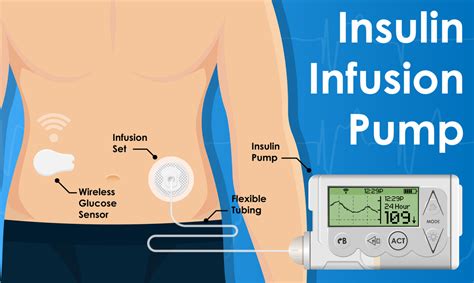What Is An Insulin Pump Dr Rishi Shukla