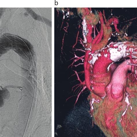 a b postoperative thoracic dsa angiography a and download