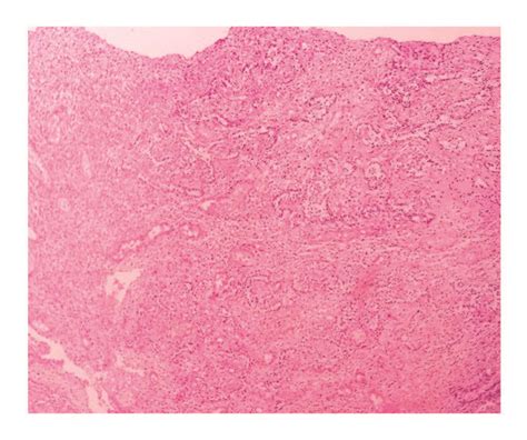 Hematoxylin Eosin Magnification 200x Clear Cell Cords Resembling