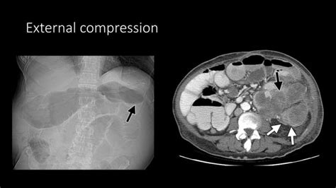 Sigmoid Volvulus Pptxerrtyiioppknjiopplmnnbvgffdd Ppt