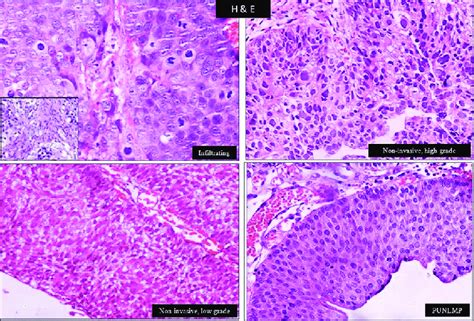 Grades Of Urothelial Neoplasm Inset Muscle Invasion In Infiltrating