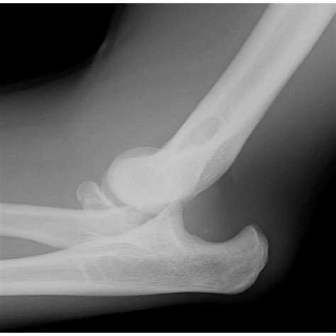 Radial Head Fracture Mason Iv Download Scientific Diagram