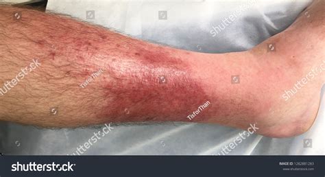 Cellulitis Infection