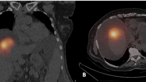 A Cases Series Of Discrepancies In Lung Shunt Fraction Calculation